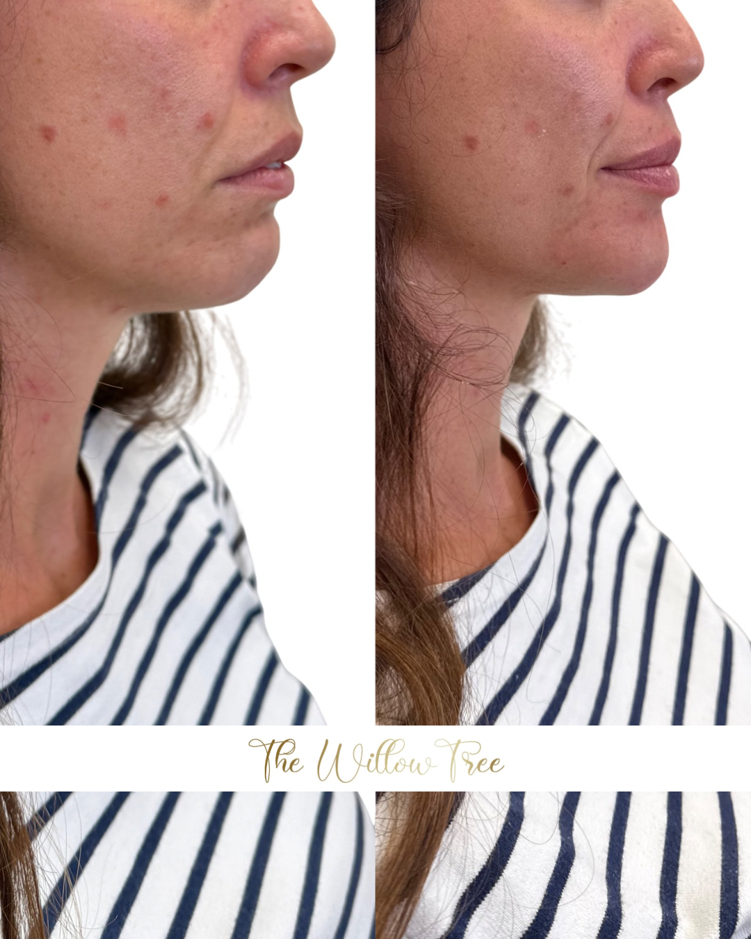 Chin Filler Norwich | The Willow Tree Aesthetics Clinic